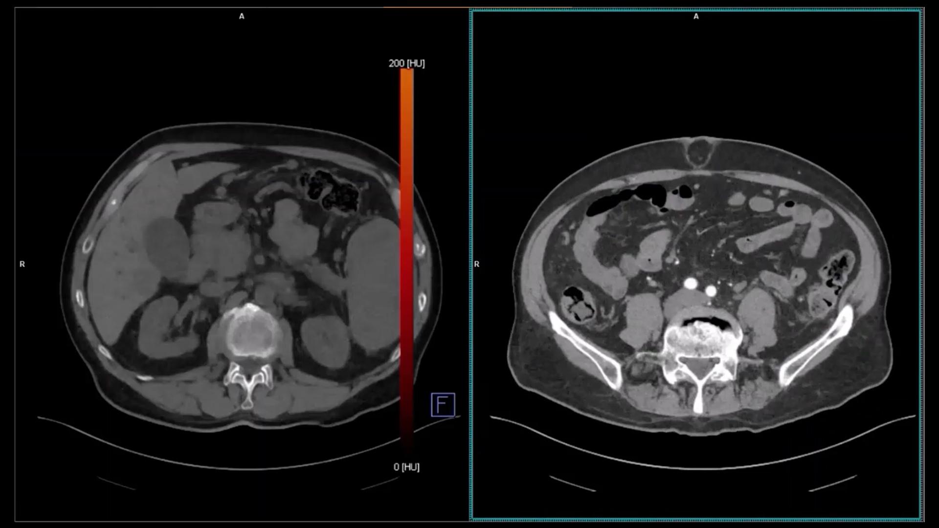 Computed Tomography Scientific Presentations - Siemens Healthineers USA