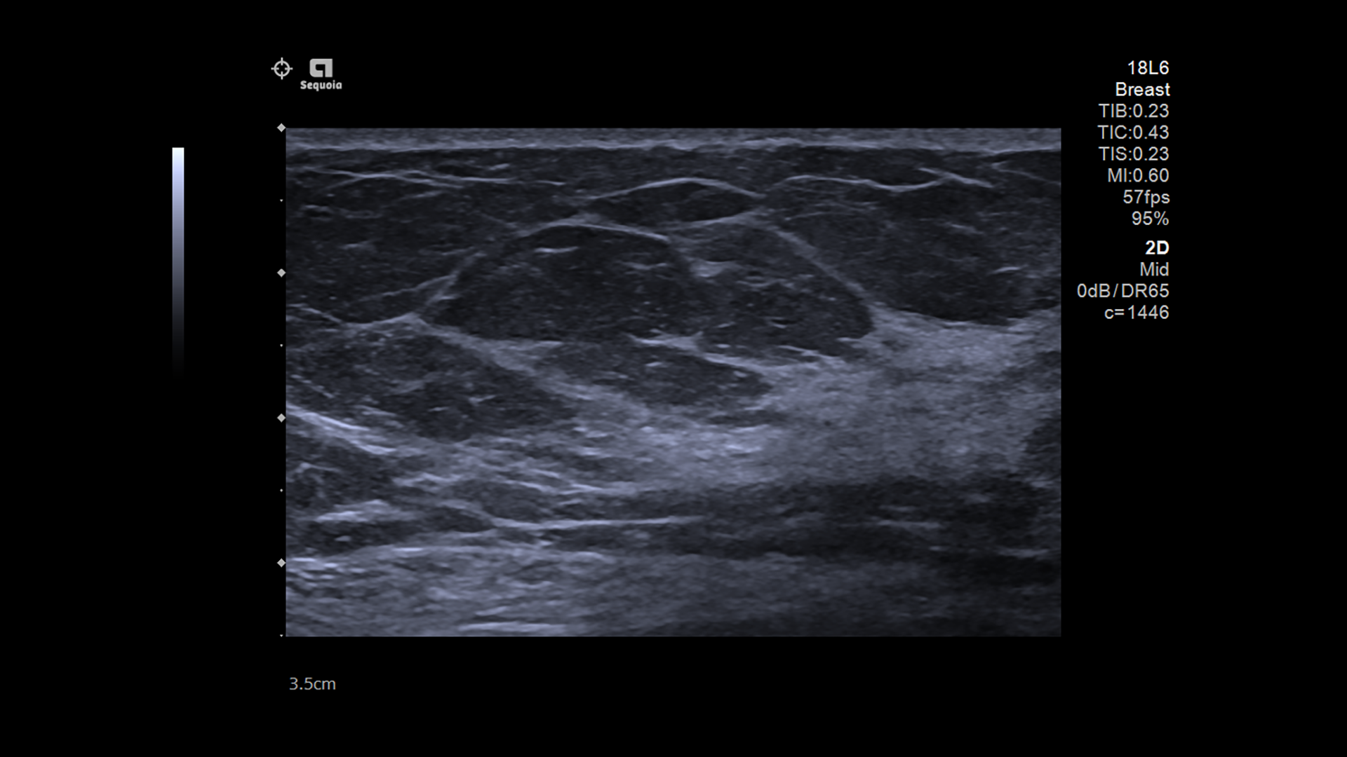 ACUSON Sequoia Ultrasound System - Siemens Healthineers
