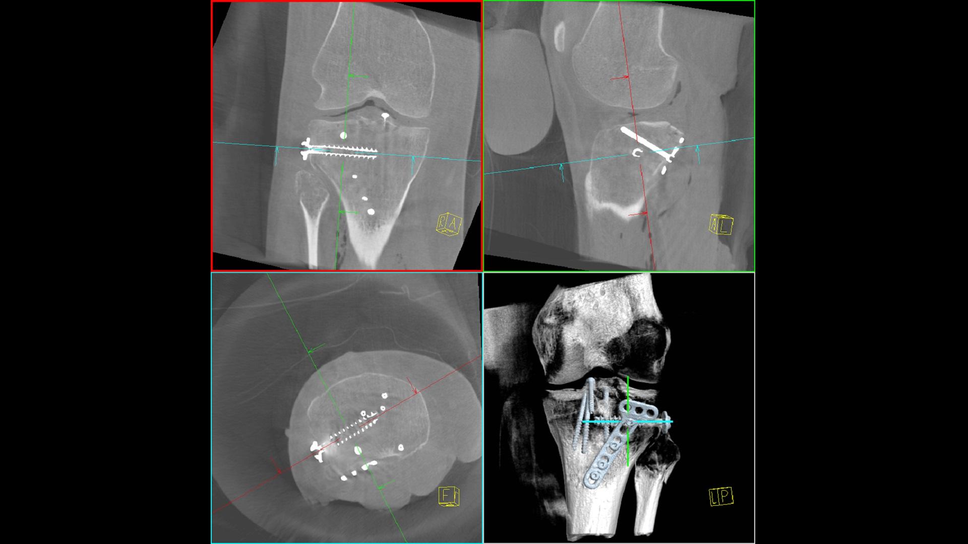 Cios Spin – Mobile C-arm machine - Siemens Healthineers
