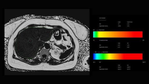 Liver Cancer Management - Siemens Healthineers