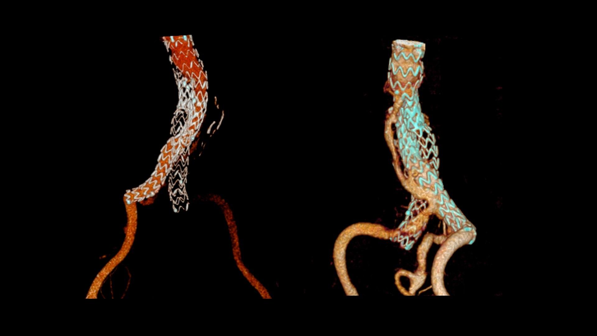 Endoleak and stent-graft occlusion after endovascular aneurysm repair
