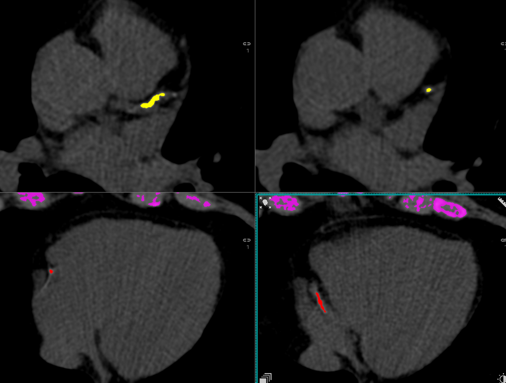 CT calcium scoring: Ultra low dose coronary Ca scoring screening technique - Case Discussion