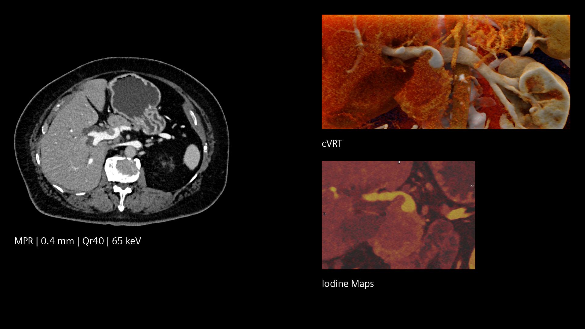 PCCT oncology imaging - Siemens Healthineers