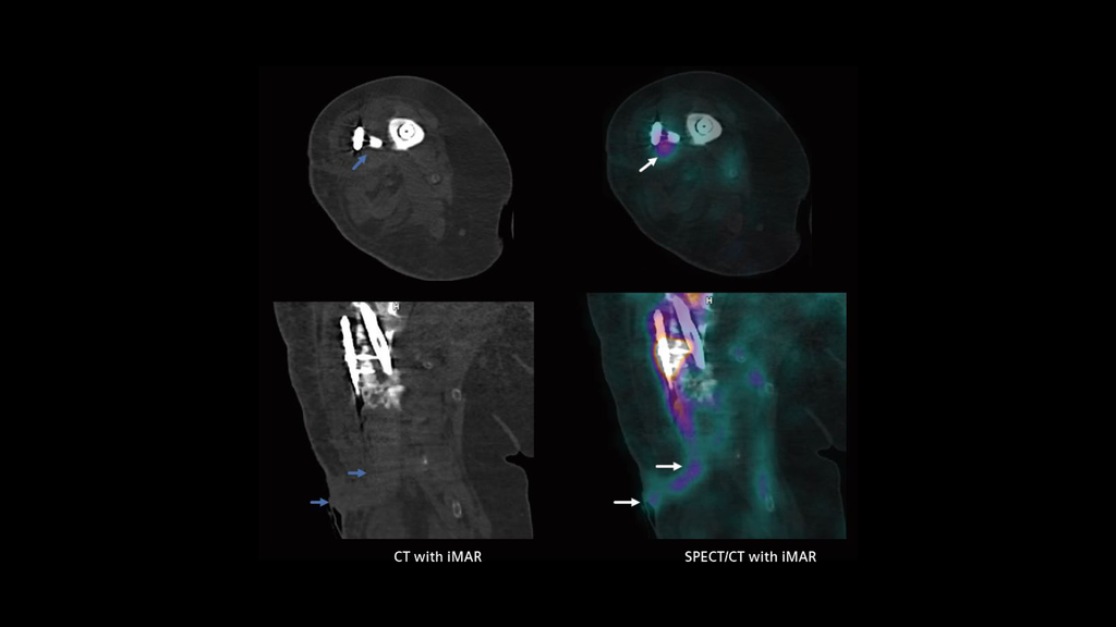 Localization Of Infection Site In Femoral Stabilization Pin - Siemens ...