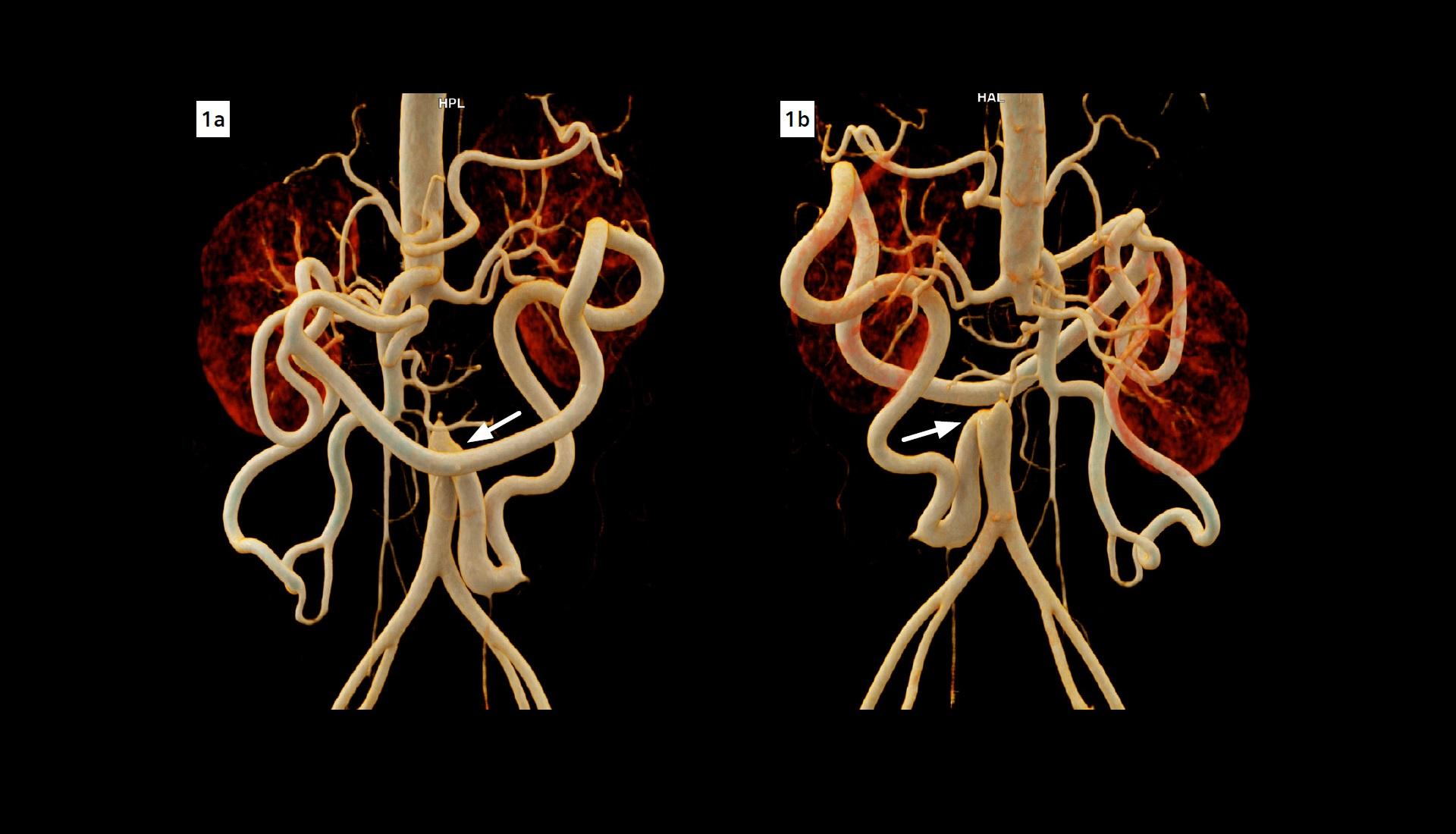 An infrarenal aortic occlusion in a young adult - Siemens Healthineers ...