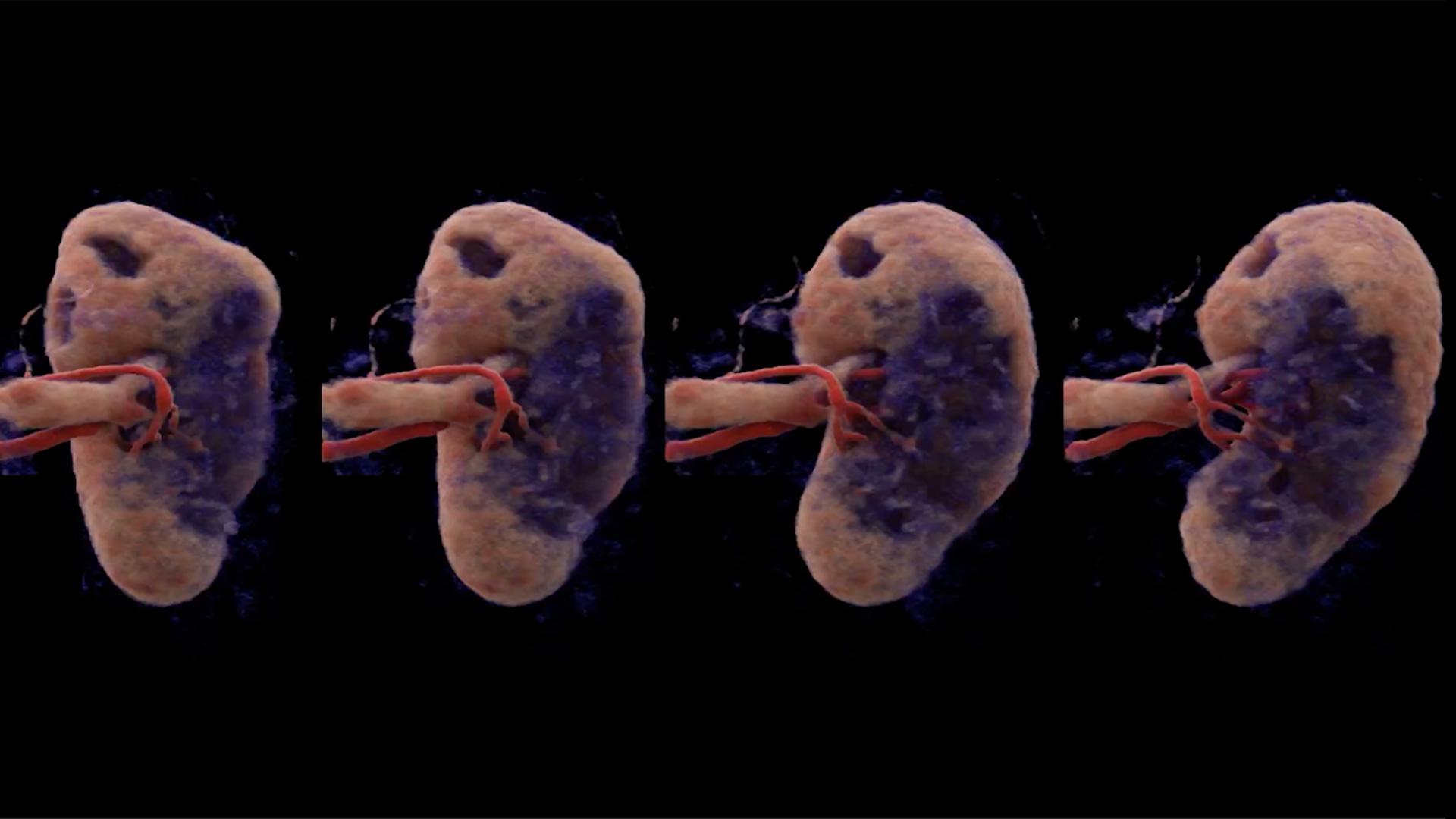 Complication of robotic renal carcinoma resection - Siemens Healthineers