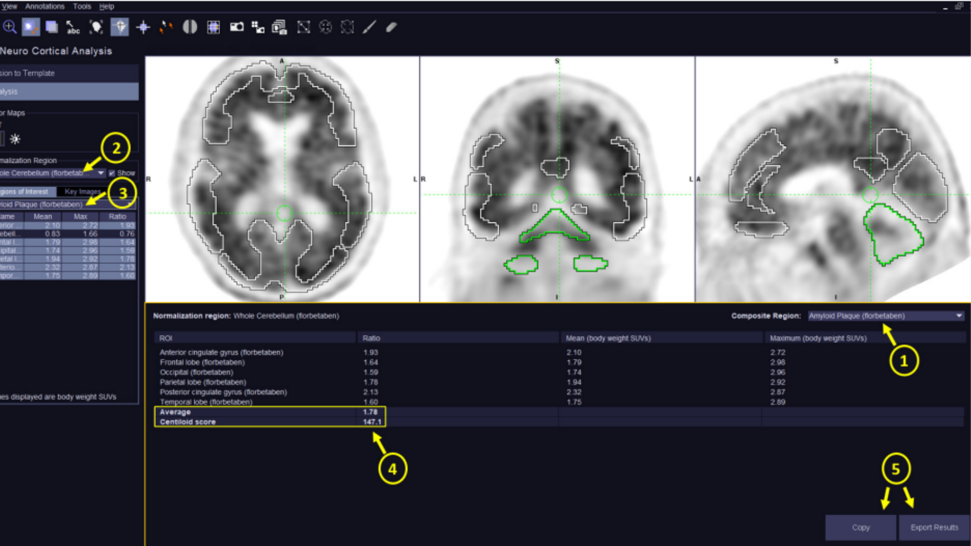syngo.MI Neurology Cortical Analysis