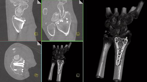Intraoperative 3D imaging in orthopedic trauma surgery - Siemens ...