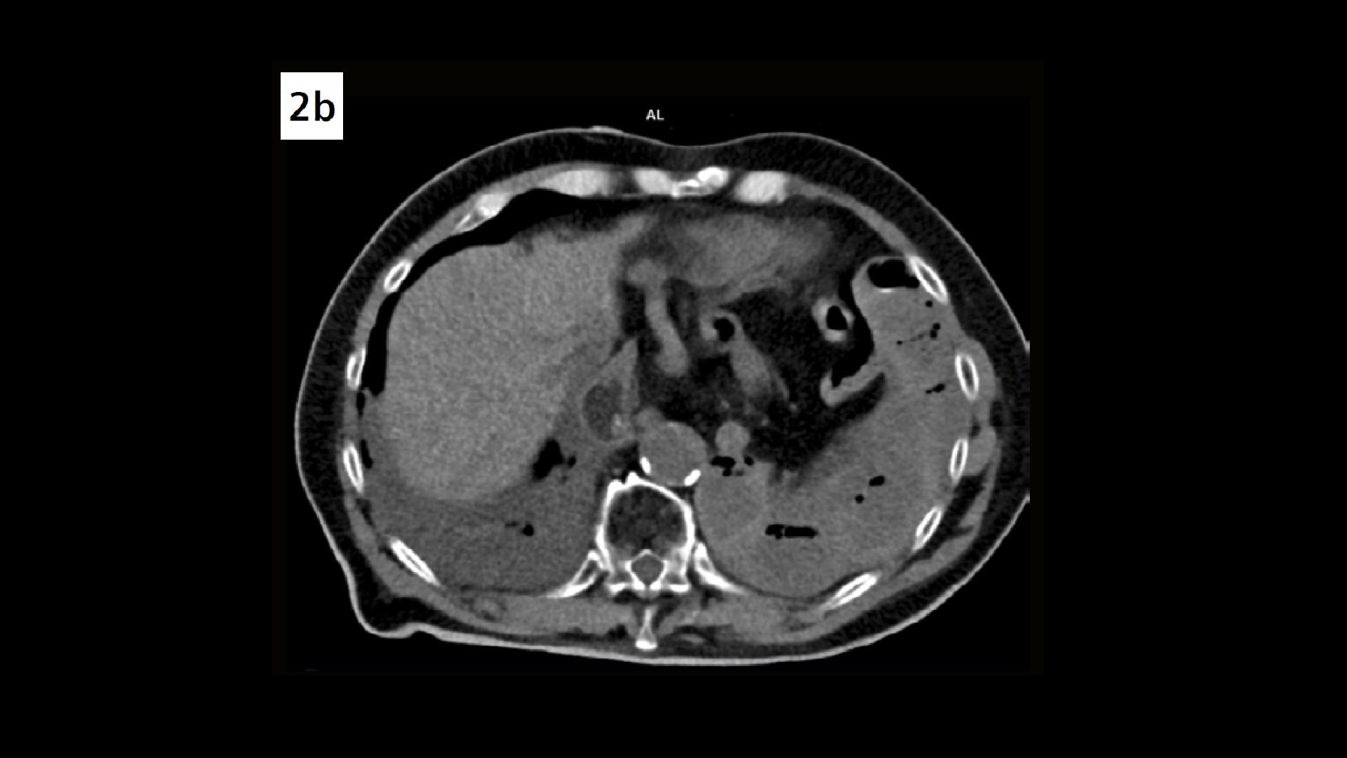 Small bowel infarction secondary to an acquired diaphragmatic hernia ...