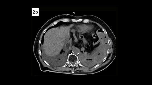 Small bowel infarction secondary to an acquired diaphragmatic hernia ...