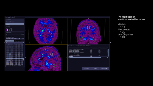 Biograph Vision PET/CT Clinical Image Gallery - Siemens Healthineers