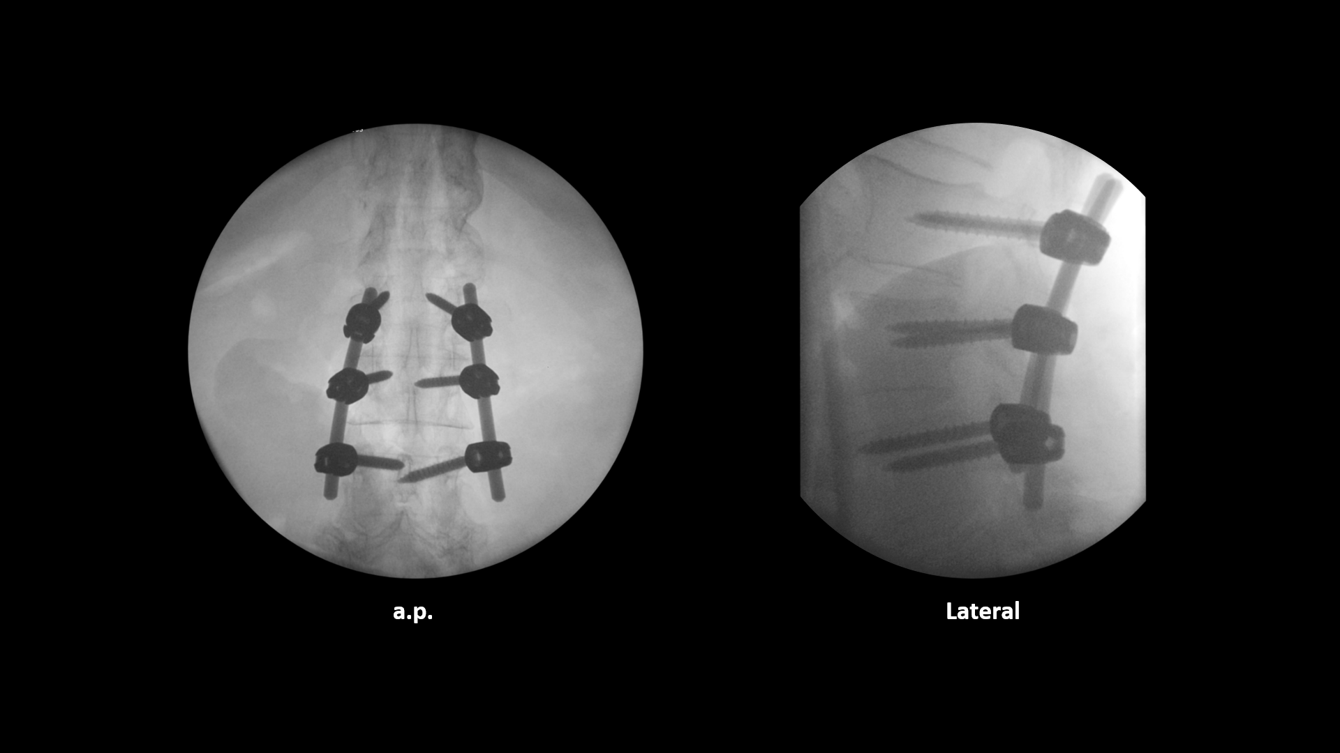 Mobile C-arm machine - Cios Select - Siemens Healthineers