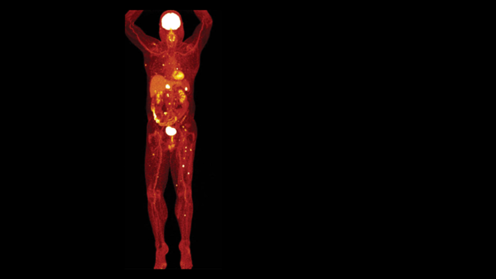 Biograph Vision PET/CT Clinical Image Gallery