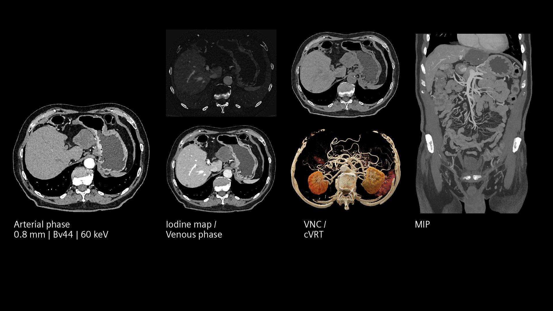 PCCT oncology imaging - Siemens Healthineers