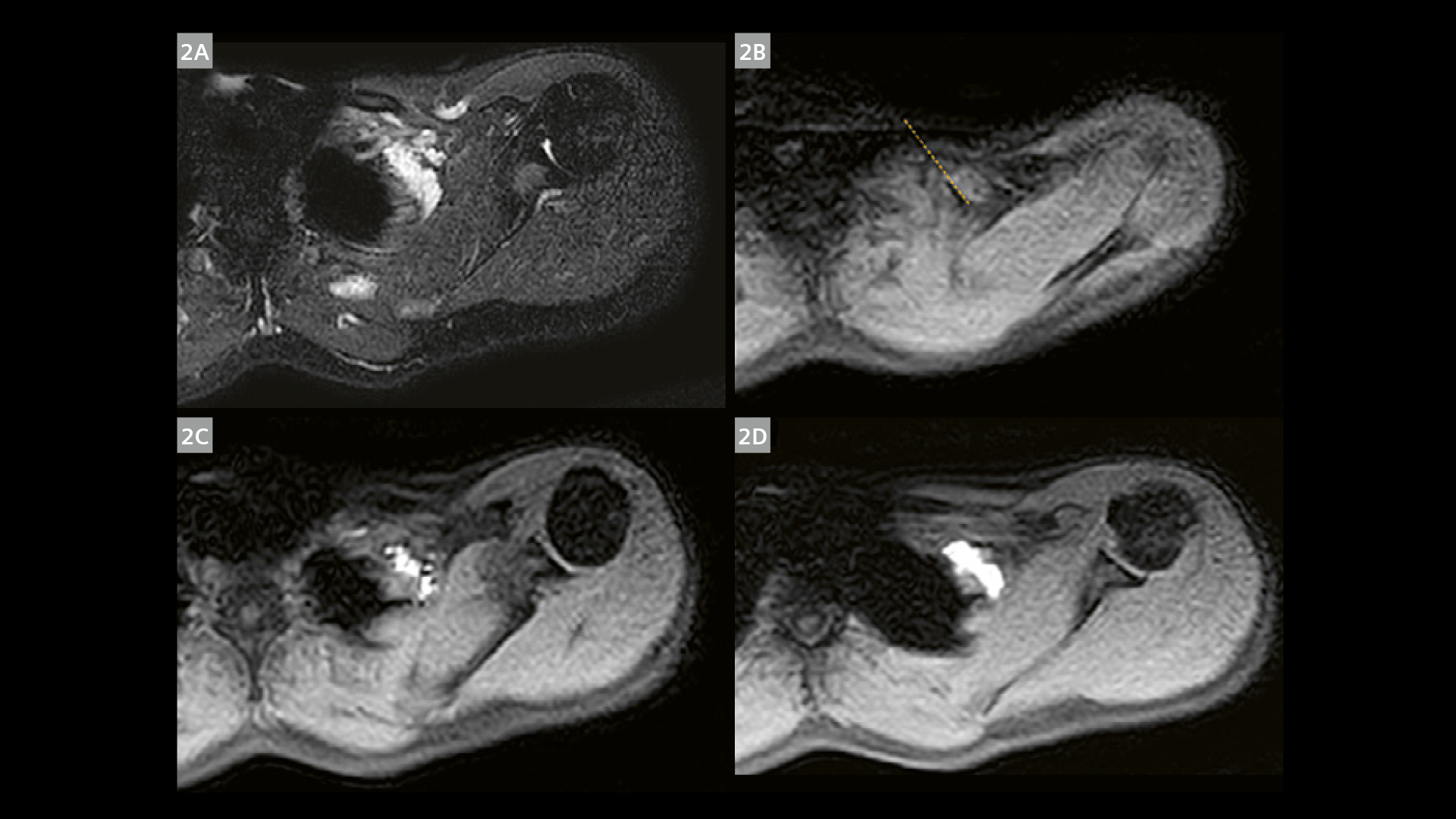 Interventional MRI Suite – Leading the way in iMRI - Siemens Healthineers