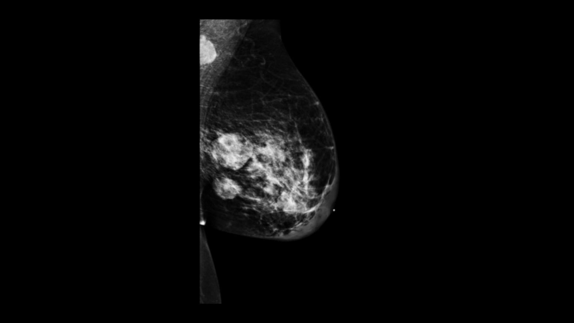 18F-FES PET/CT distinction of ER-positive lesions in a patient with ...