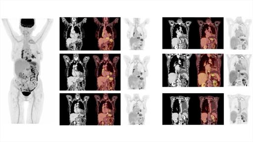 18F-FDG PETCT delineation of predominantly pericardial involvement in ...
