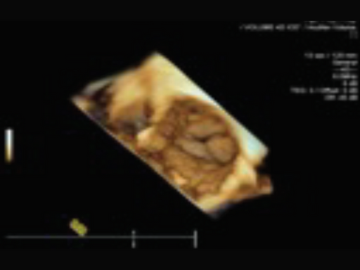 Intracardiac Echocardiography with AcuNav Ultrasound Catheters ...