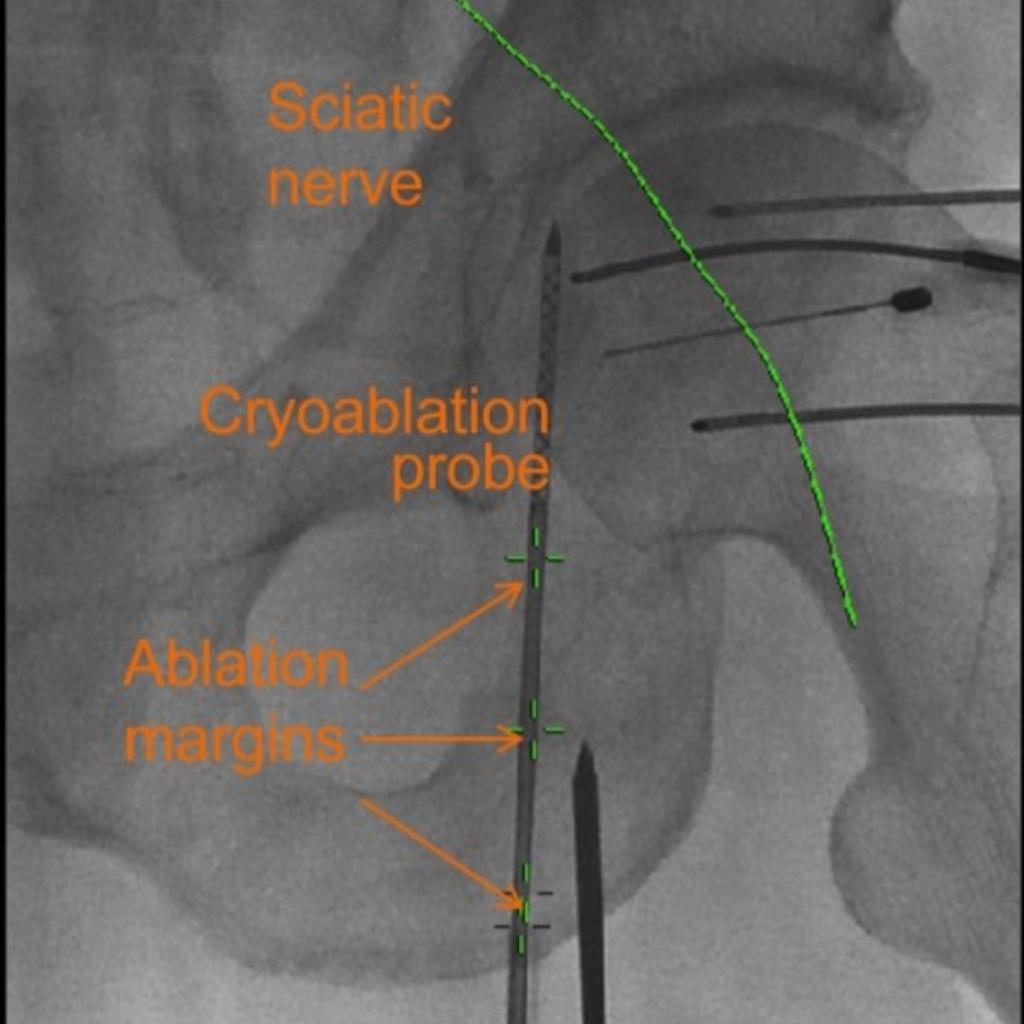 Interventional Oncology Procedures - Siemens Healthineers
