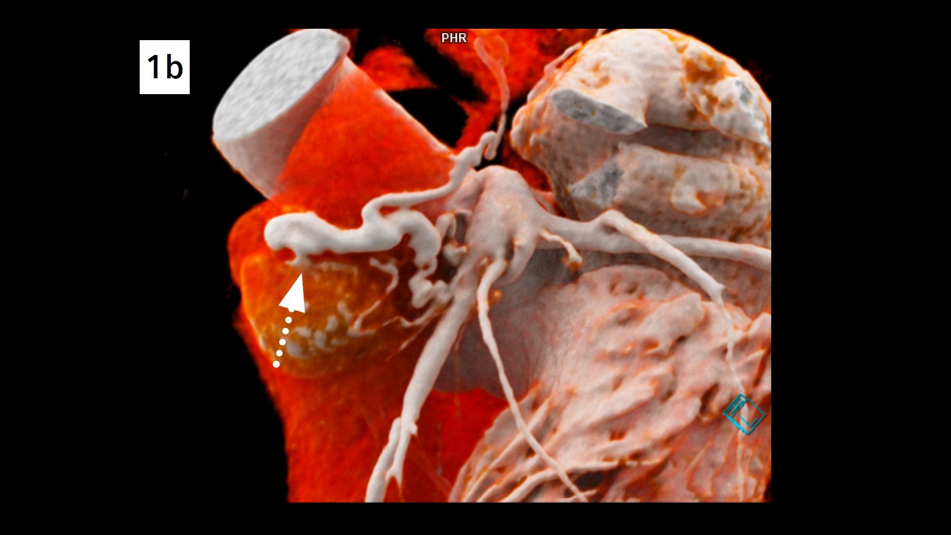 Complex Coronary Artery Fistulas & Aneurysm in an Asymptomatic Patient ...