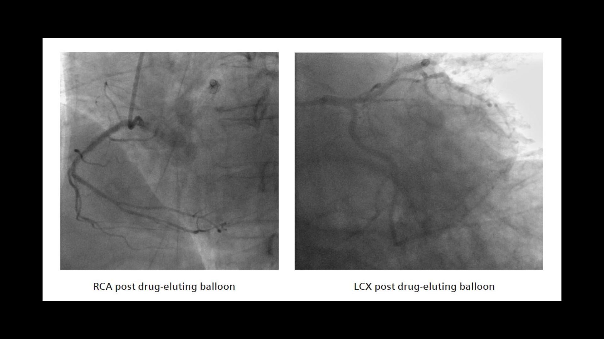 PET/CT delineation of multivessel coronary artery disease and post ...