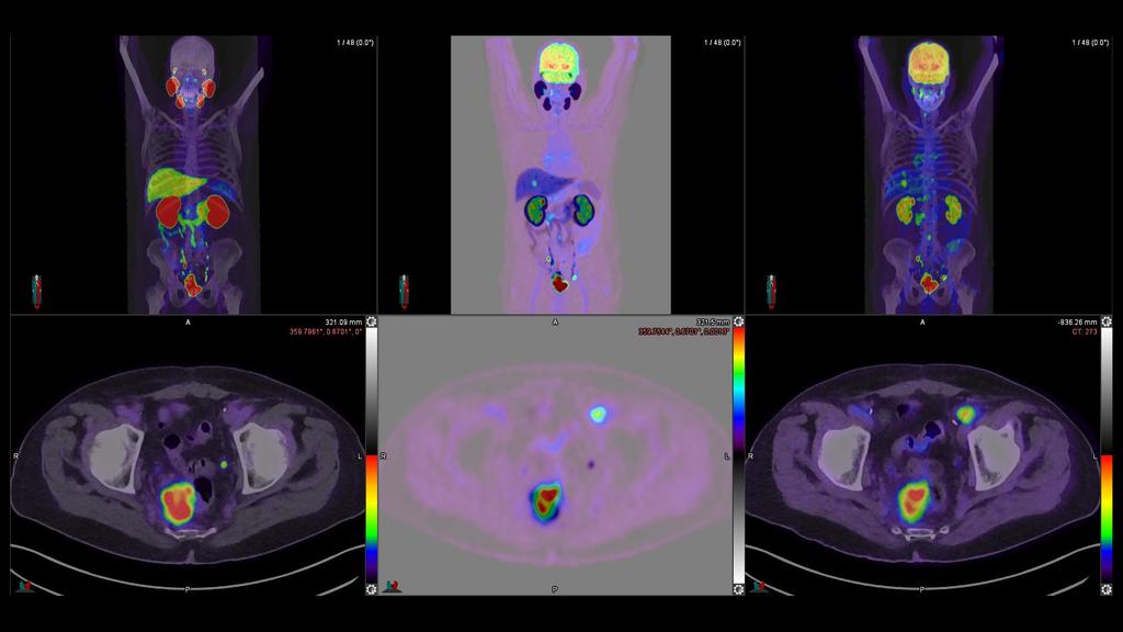 Next-level theranostics with total-body PET/CT