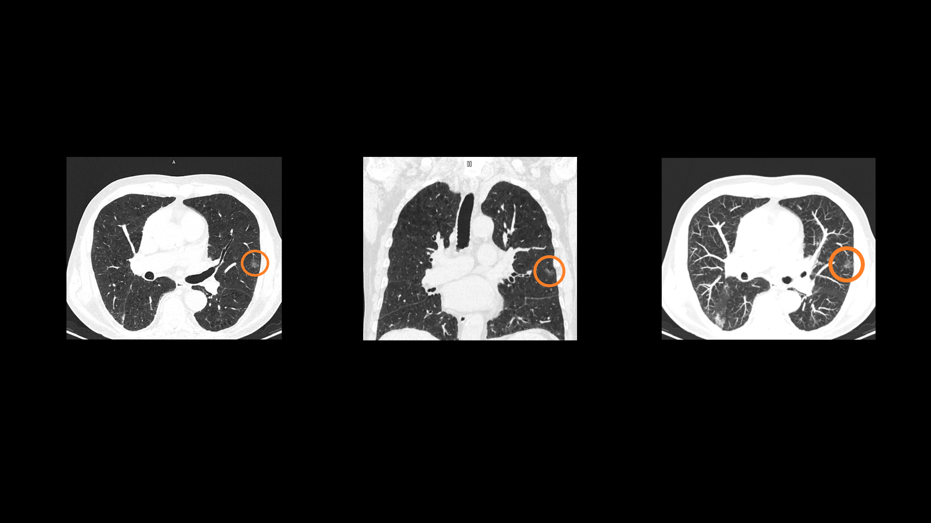 CT-guided interventional procedures on SOMATOM go.platform - Siemens ...