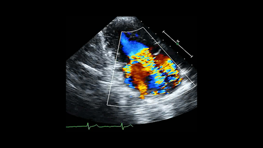 MitraClip Case Study
