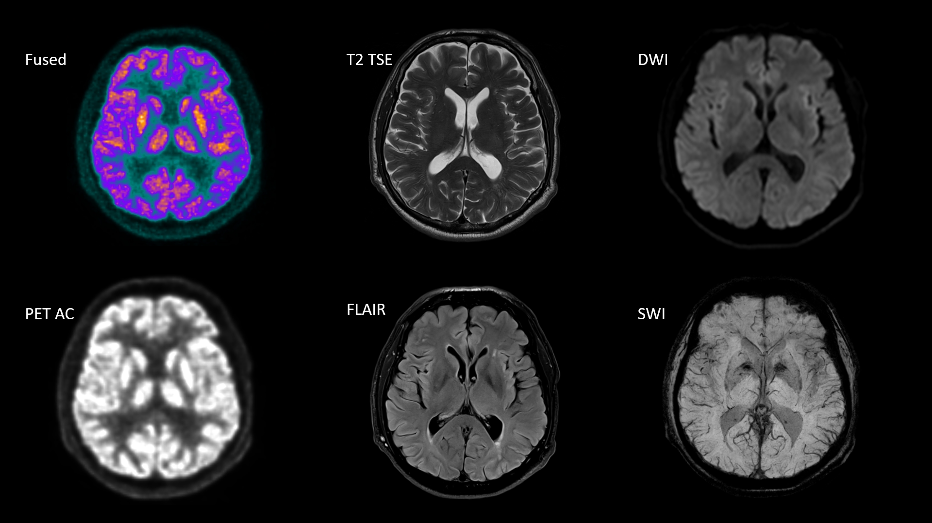 PET/MR imaging