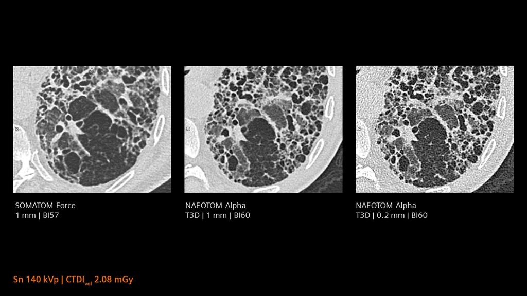 NAEOTOM Alpha - Applications pulmonaires - Siemens Healthineers France