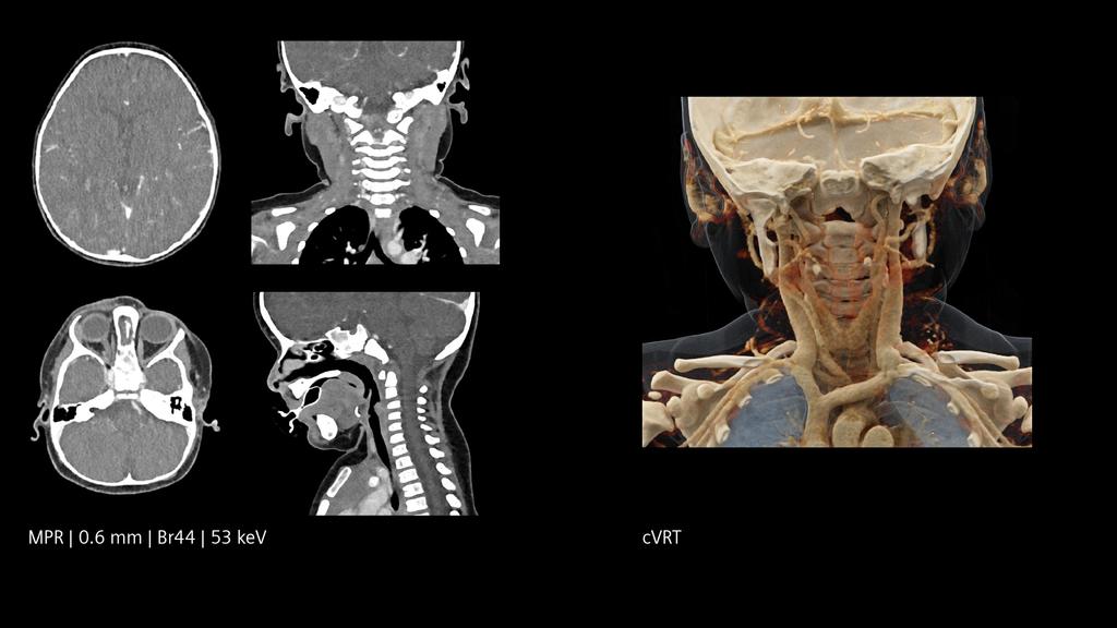 PCCT pediatric imaging - Siemens Healthineers USA