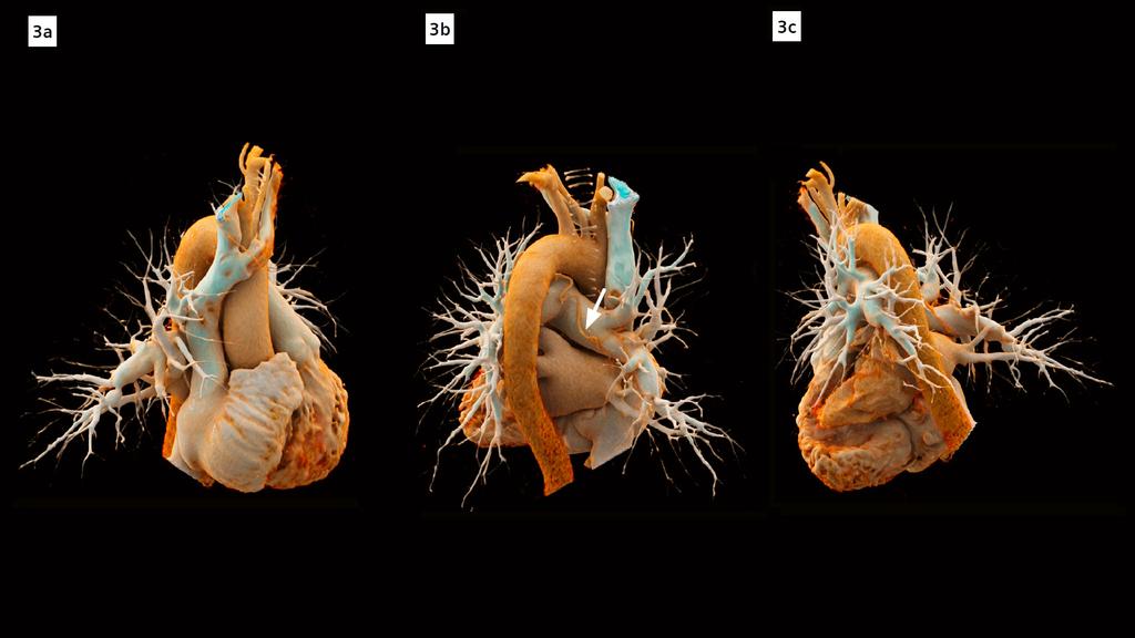 Chronic thromboembolic pulmonary hypertension diagnosed after COVID-19 ...