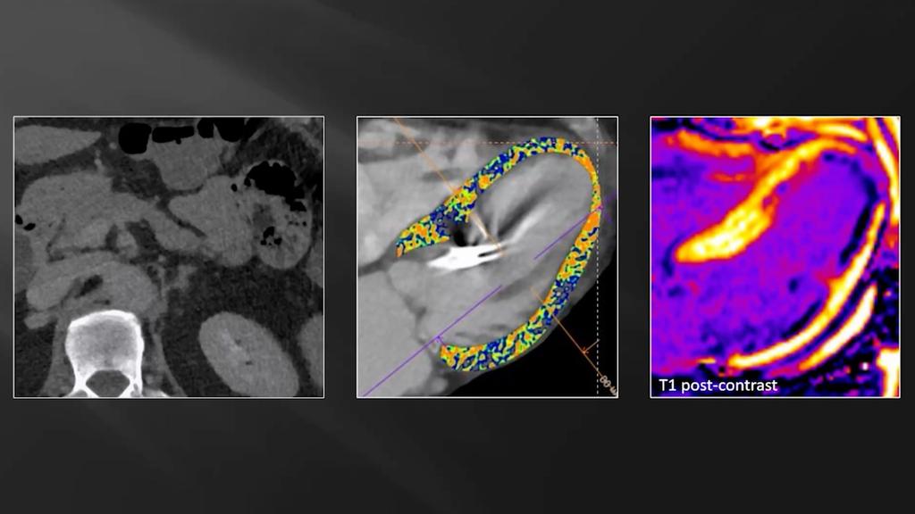 PCCT scientific evidence - Siemens Healthineers