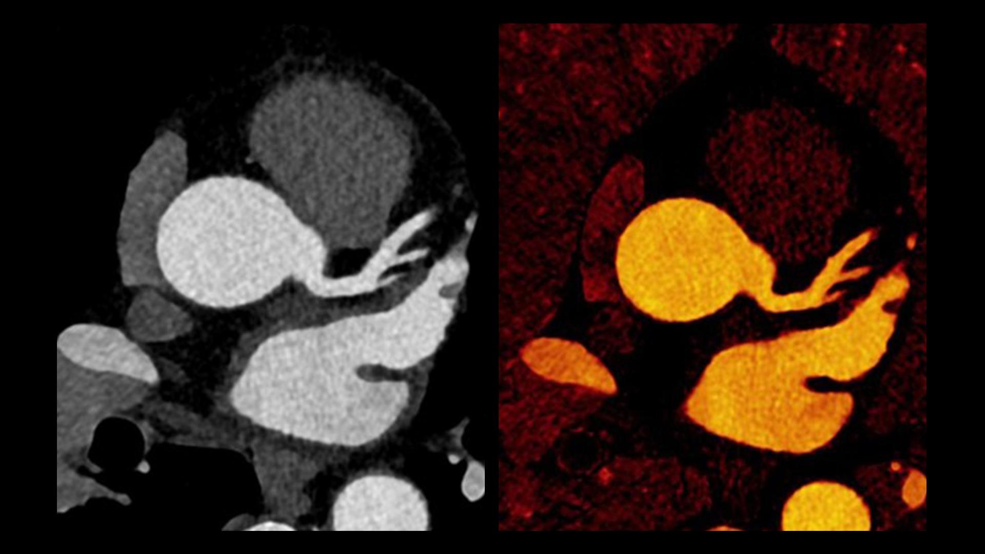 PCCT cardiovascular imaging - Siemens Healthineers