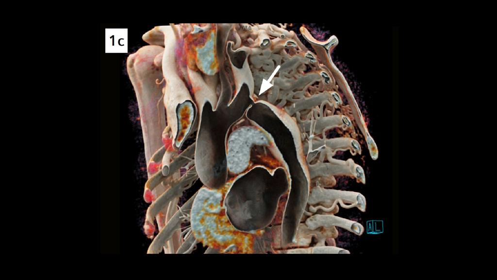 Severe aortic coarctation in an adult - Siemens Healthineers
