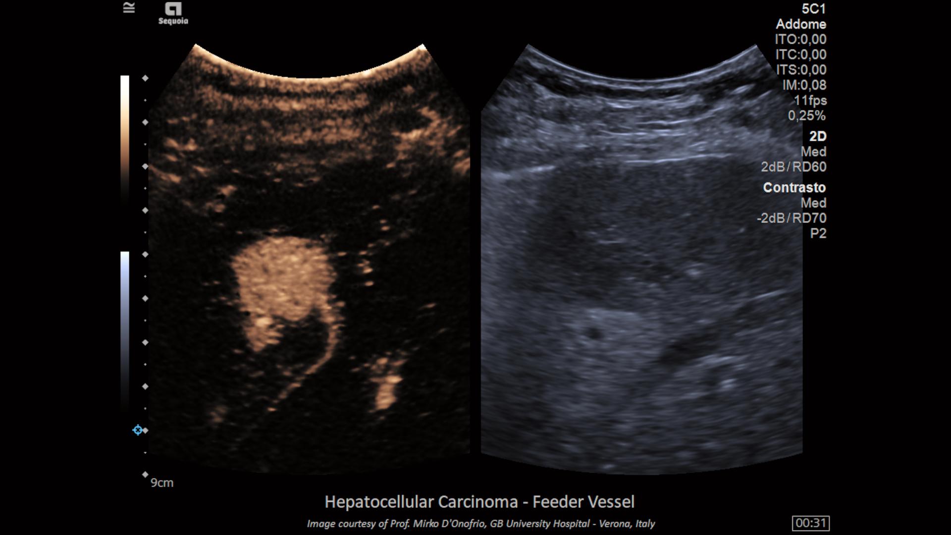 Liver Cancer Management - Siemens Healthineers