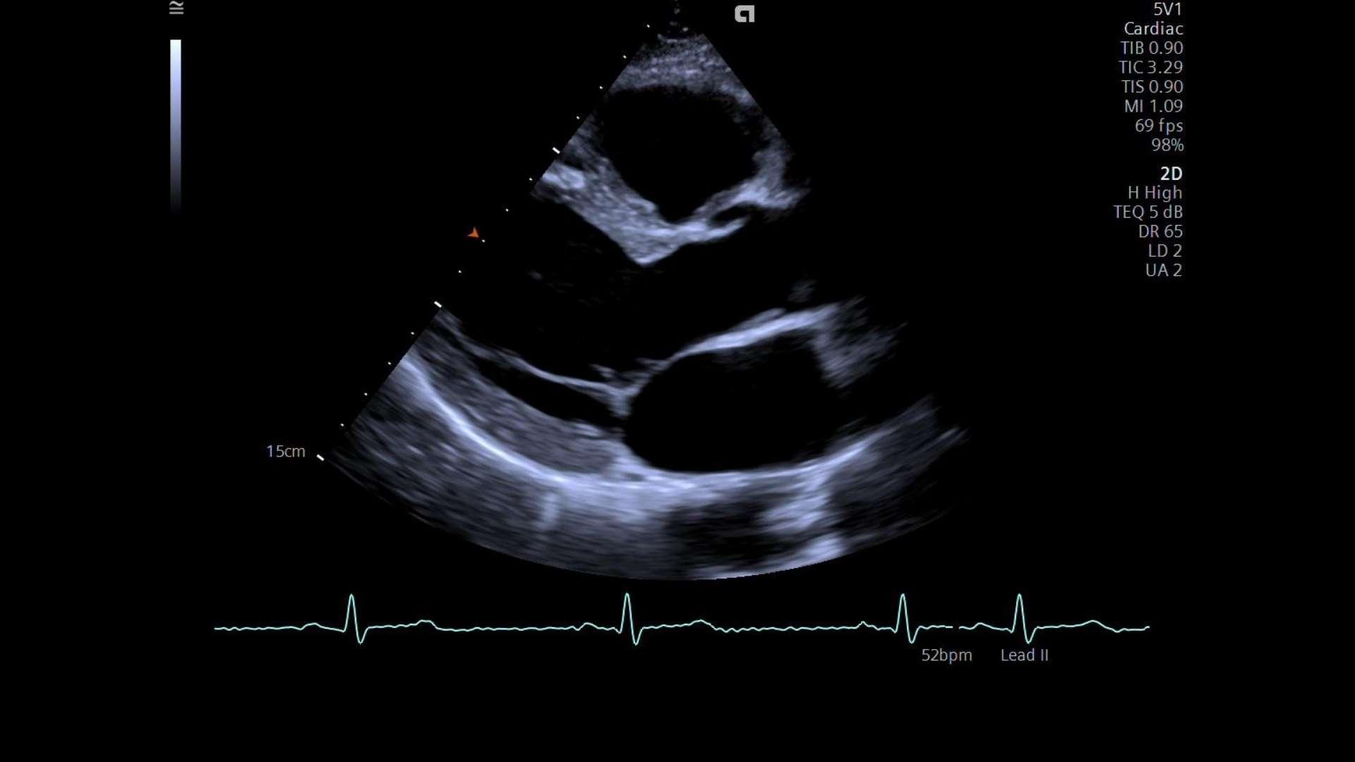 ACUSON Redwood, CV Edition Ultrasound System, CV Edition - Siemens ...