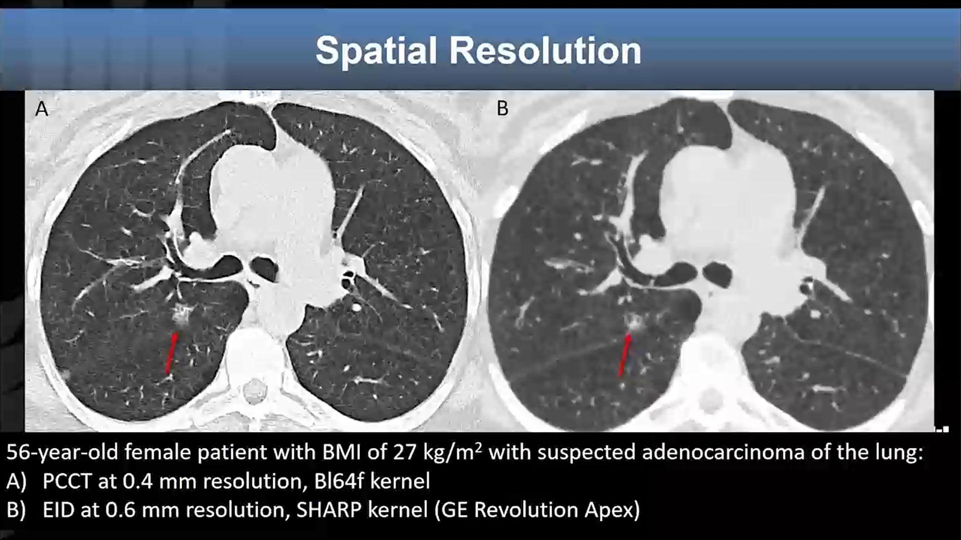 Real World Results Impact Of Photon Counting Ct In The Assessment Of Lung Cancer