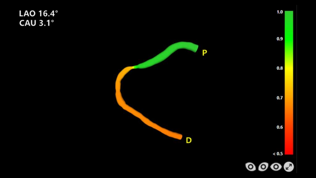 Rethink FFR assessment for every patient - Siemens Healthineers