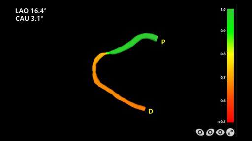 Rethink FFR assessment for every patient - Siemens Healthineers