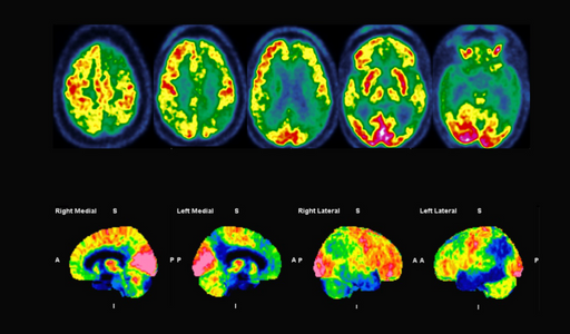 Decoding Brain Metabolism: Insights from 18F-FDG PET/CT Studies using ...