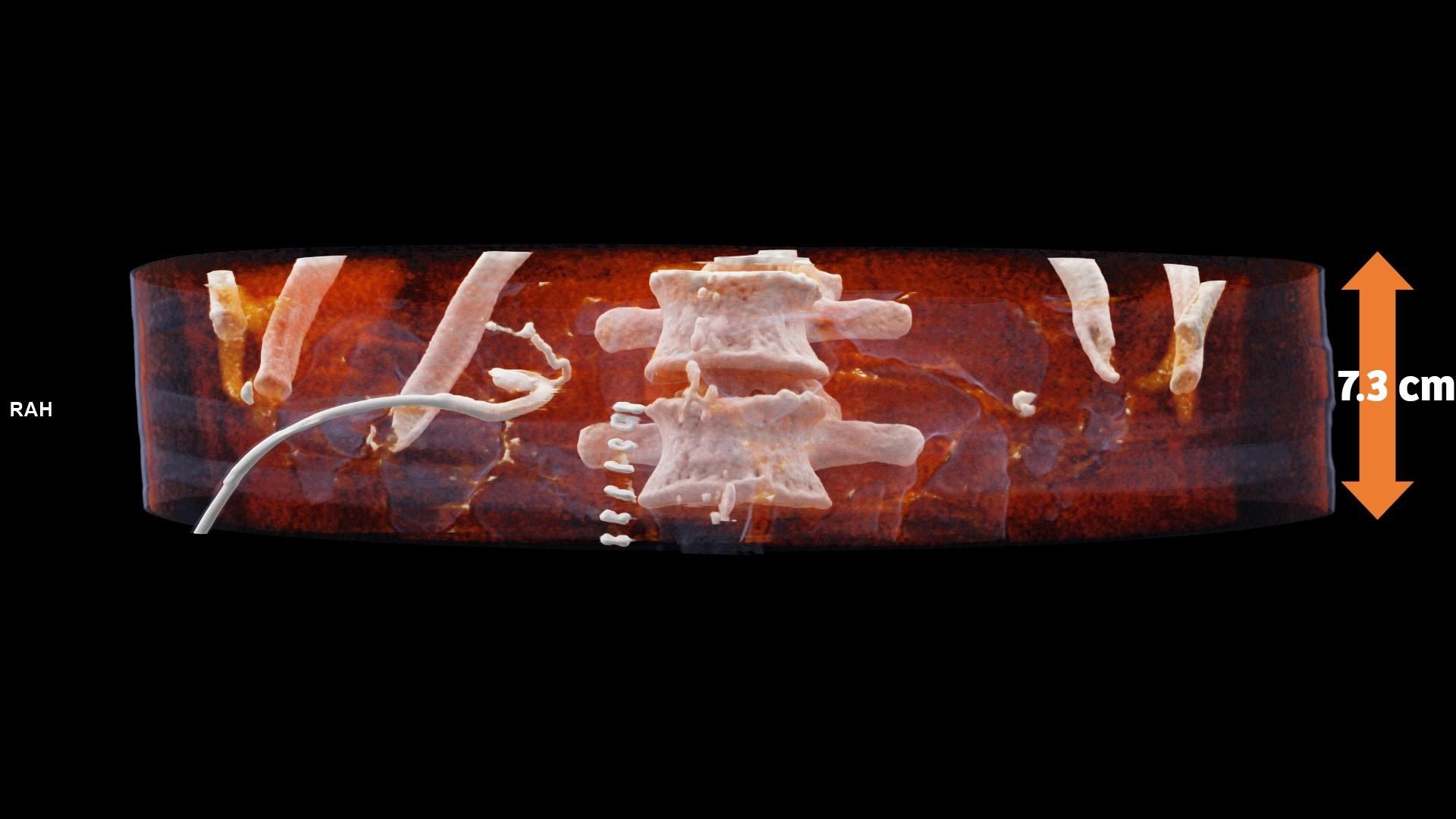 CT-guided interventional procedures on SOMATOM go.platform - Siemens ...