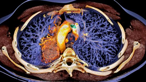 Cinematic Rendering in medical imaging - Siemens Healthineers