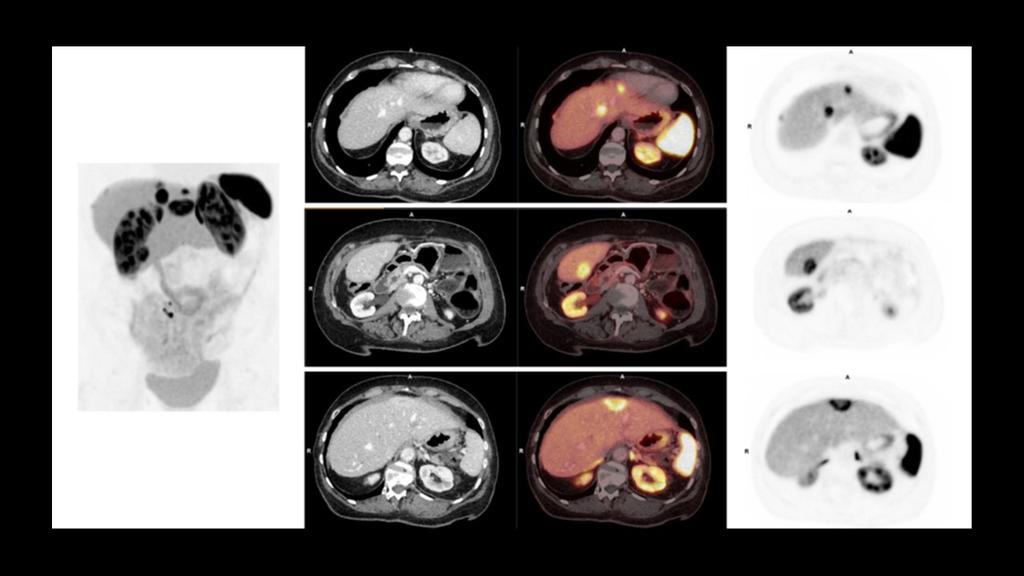 5-minute, low-dose, single-bed, whole-body F-SiFAlin-TATE PET/CT delineation - Siemens Healthineers