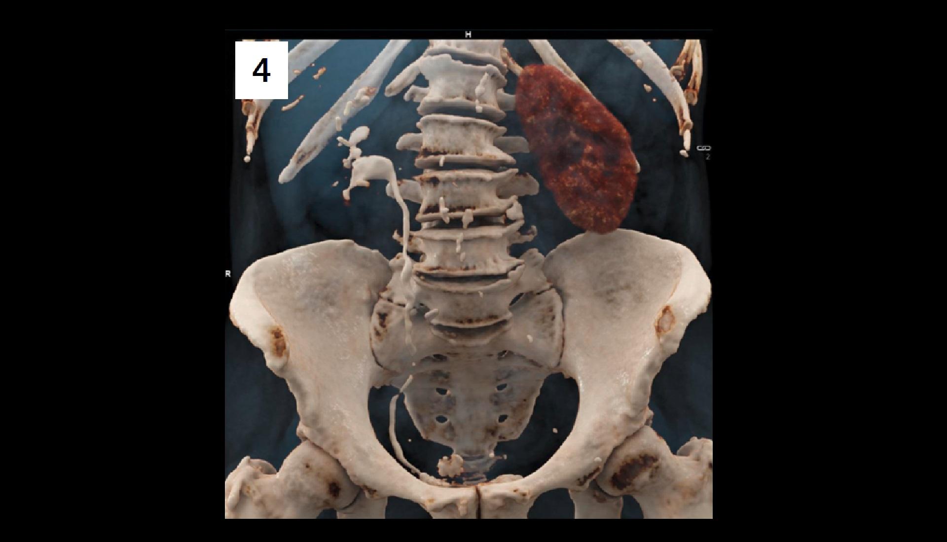 Severe ureteral obstruction secondary to an upper urinary tract ...