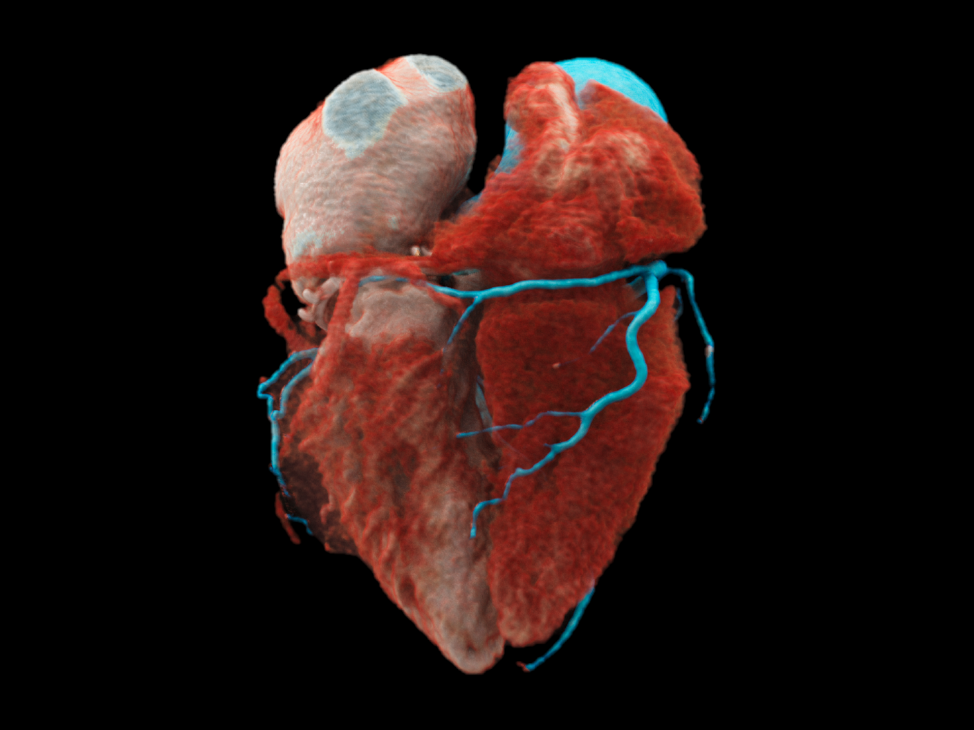 PCCT cardiovascular imaging - Siemens Healthineers USA