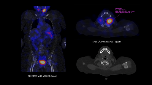 Theranostics for Personalized Cancer Care - Siemens Healthineers USA