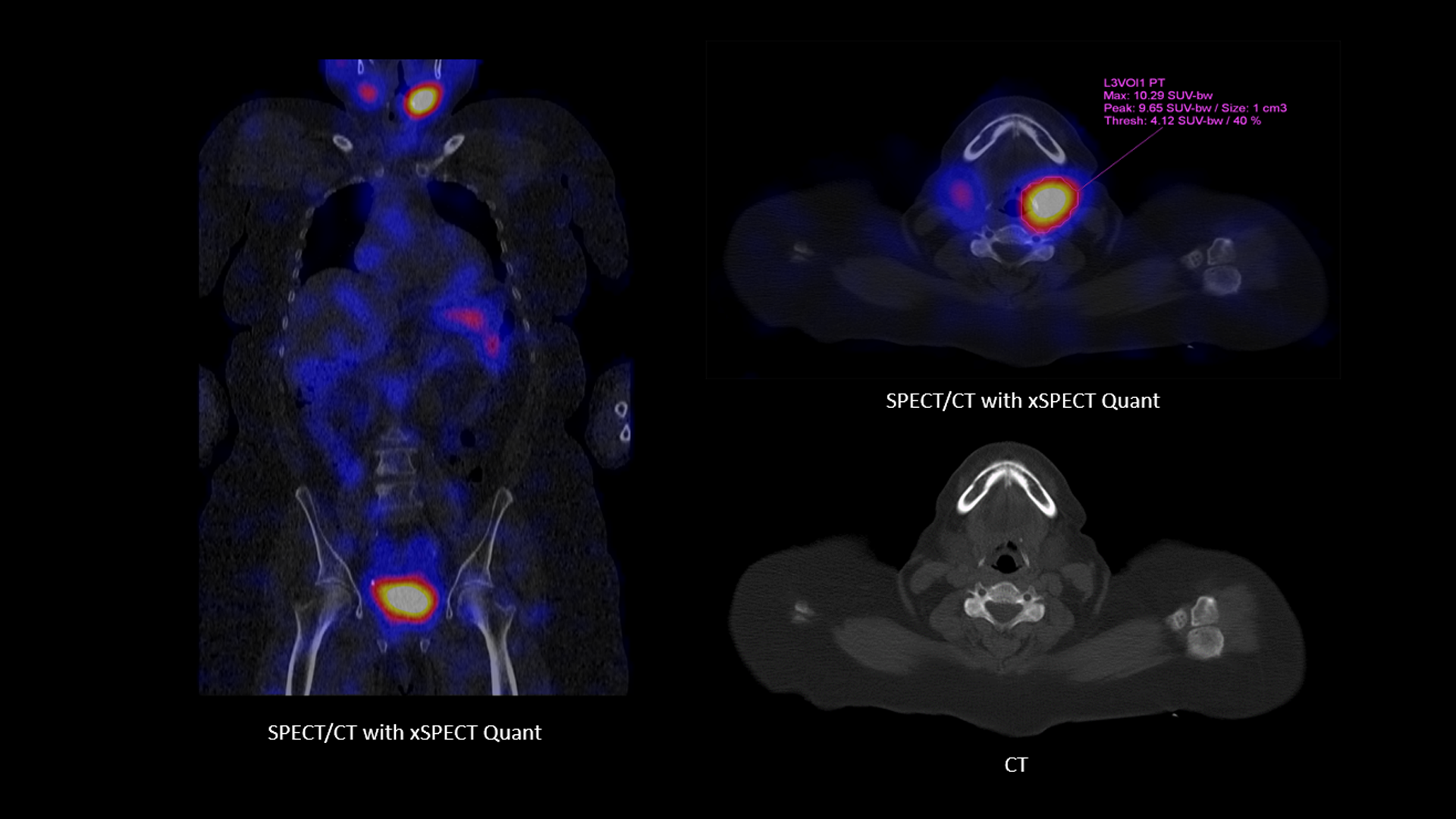 Theranostics for personalized cancer care - Siemens Healthineers