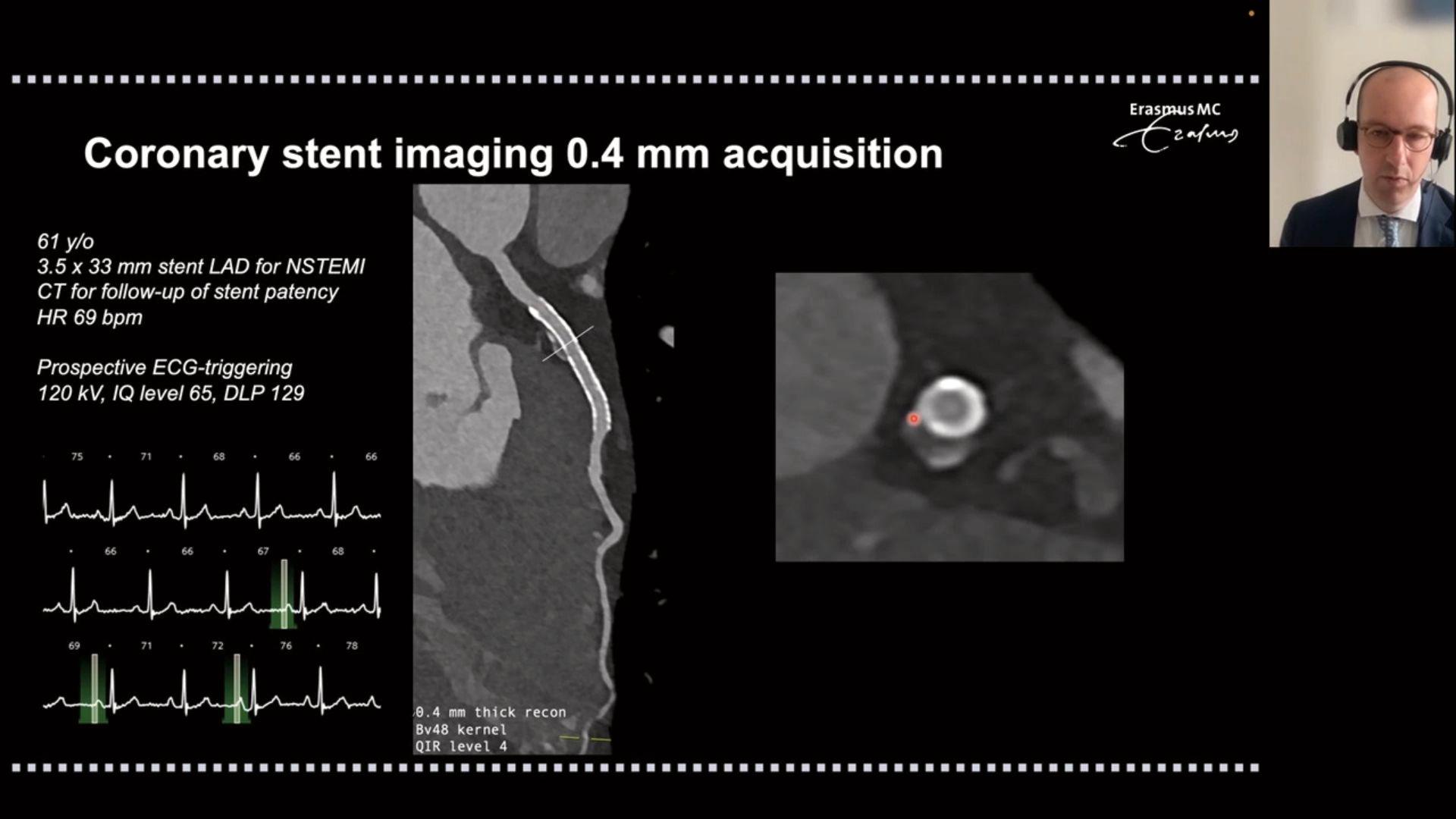 Real-world results: Cardiovascular imaging with photon-counting CT ...