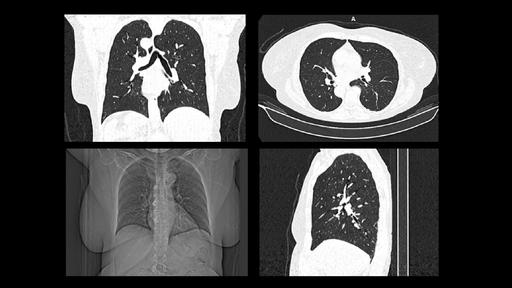 Diagnosis And Treatment Of Lung Cancer - Siemens Healthineers